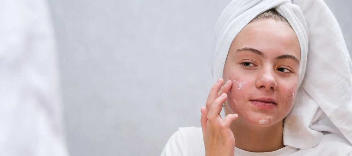 Retentional acne vs. inflammatory acne: how to treat it? – KADALYS